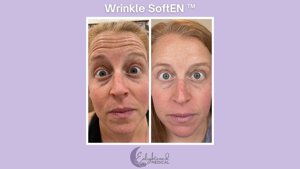 Neuromodulator Injections (Botox) in Davie, FL — Enlightened Medical